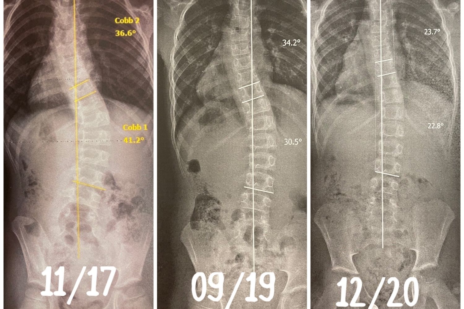 Rigo Cheneau Brace Provides Growth-Guided Correction | National ...